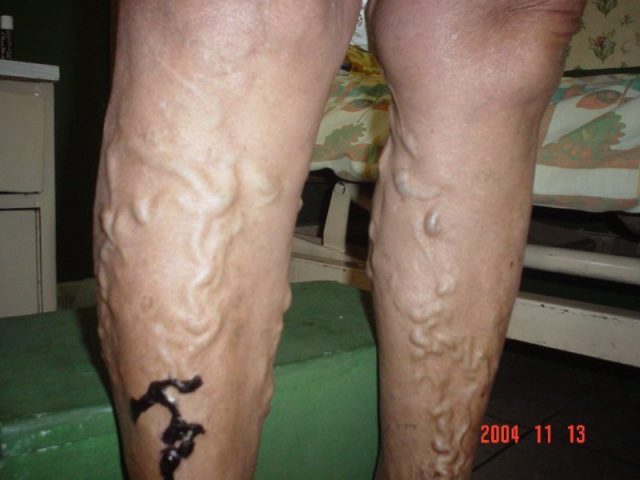 Elimina Varices - Medicina Sana